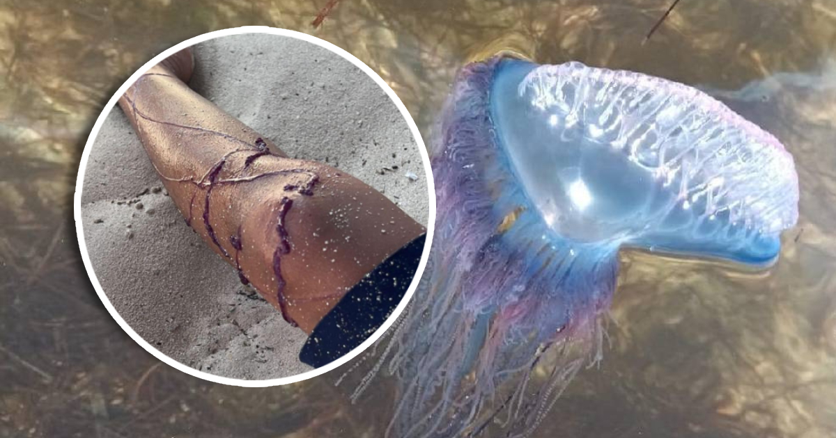 Guardavidas atienden a menor que sufrió picadura de agua mala en Playa ...